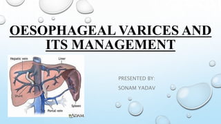 Oesophageal varices ppt slideshare | PPTX