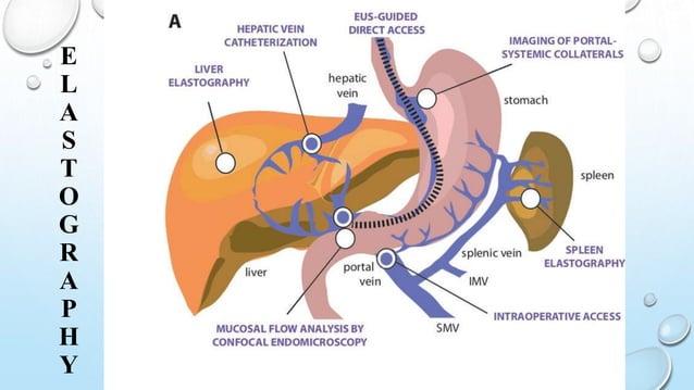 Oesophageal varices ppt slideshare | PPTX