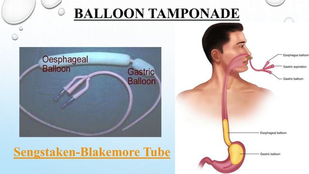 Oesophageal varices ppt slideshare | PPTX