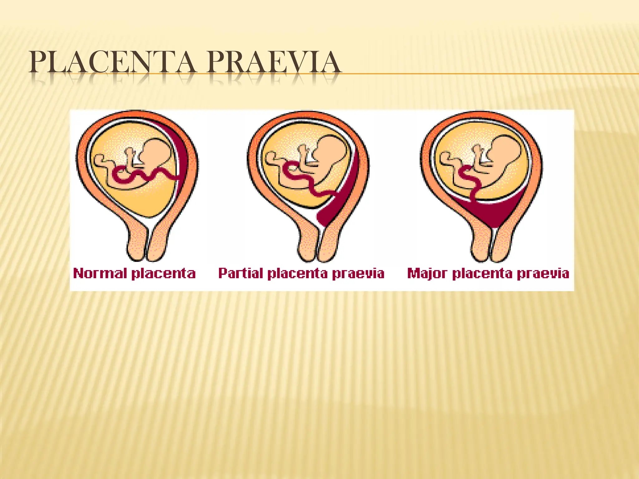 Placenta previa | PDF