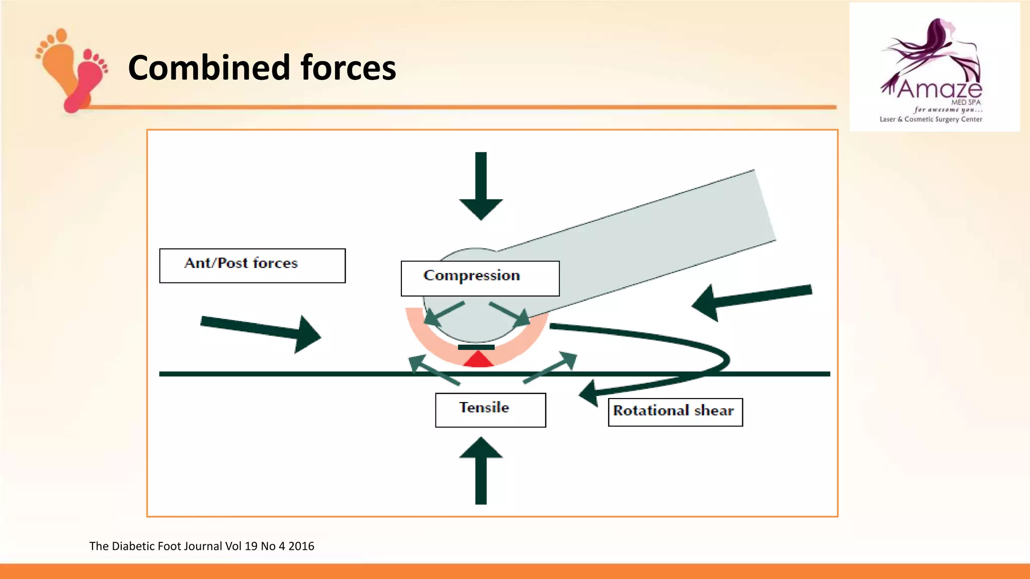 Offloading in diabetic foot | PPTX