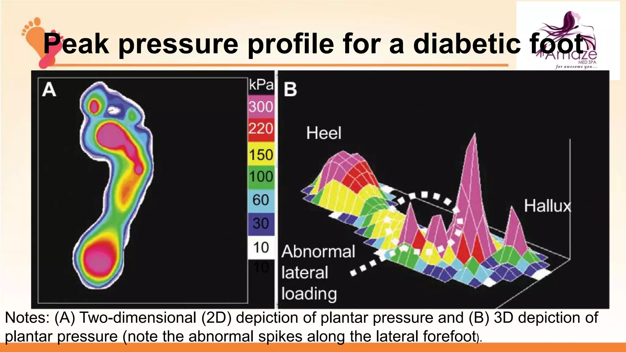 Offloading in diabetic foot | PPTX