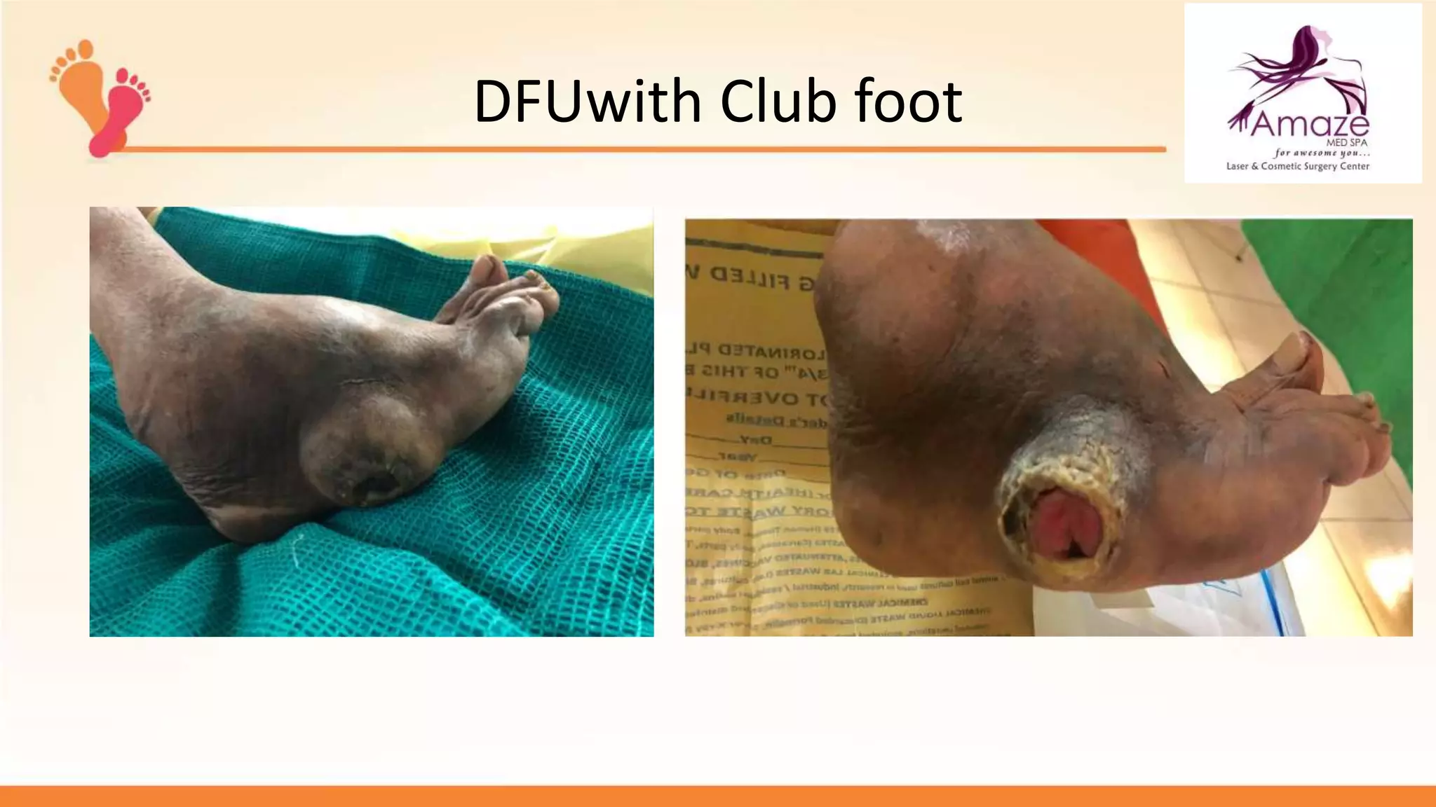 Offloading in diabetic foot | PPTX