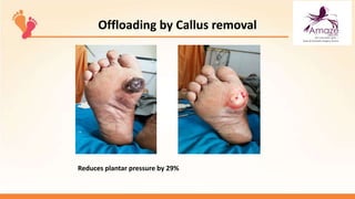 Offloading in diabetic foot | PPTX
