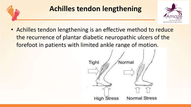 Offloading in diabetic foot | PPTX