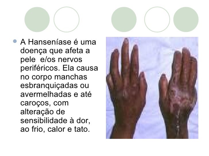 Oficina De Slides Hanseniase Tem Cura