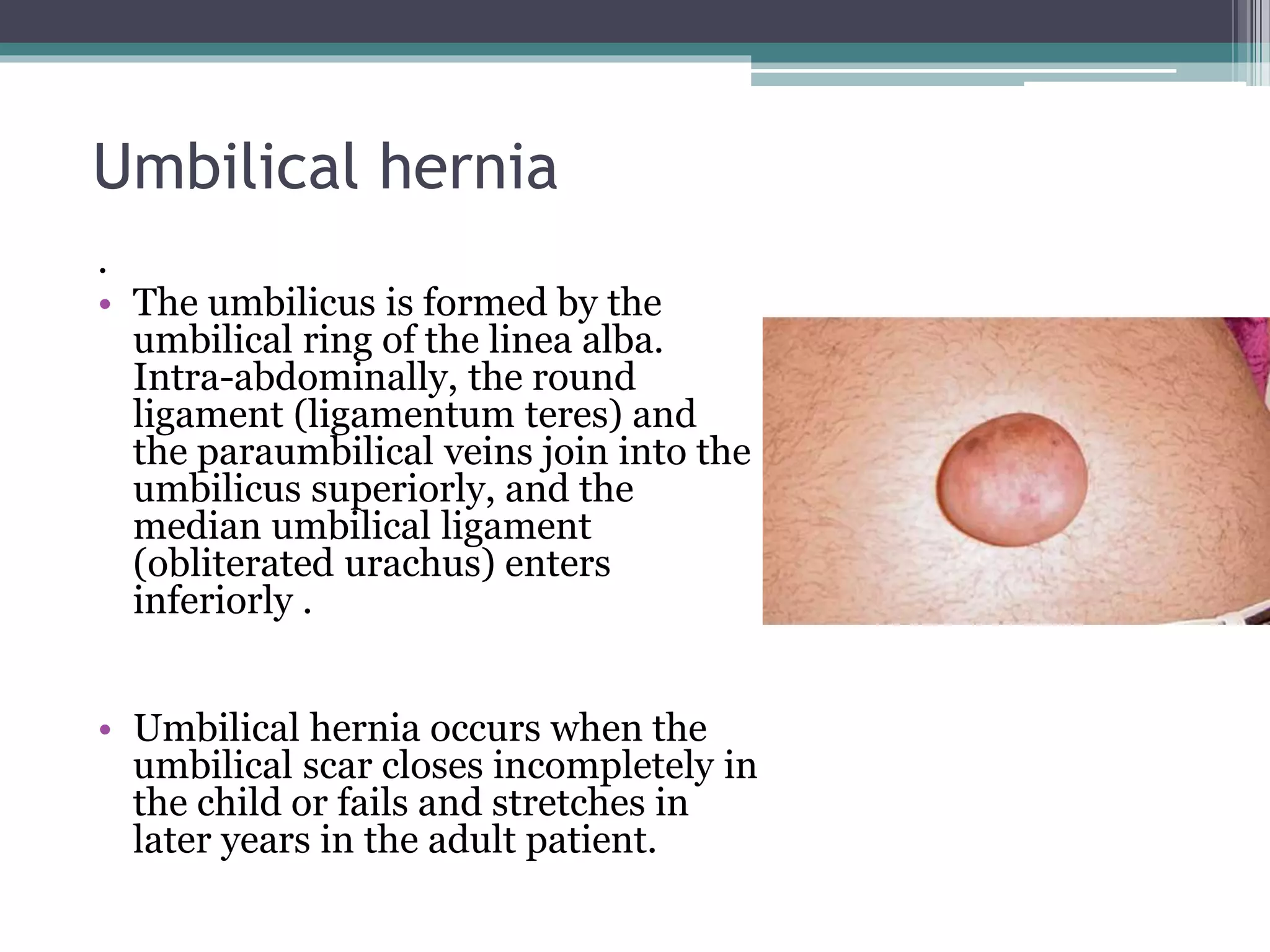 Ventral hernias | PPTX