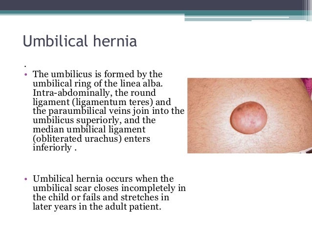Ventral hernias