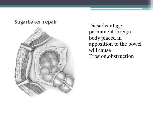 Ventral hernias