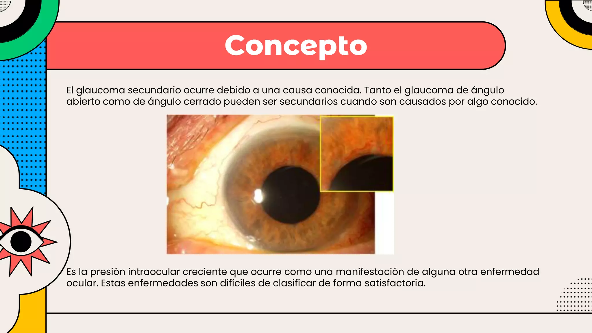oftalmo_1-2022Glaucoma_secundario.pptx