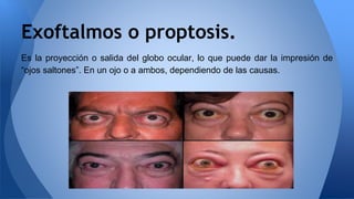 Patología vía lagrimal y exoftalmos. | PPT