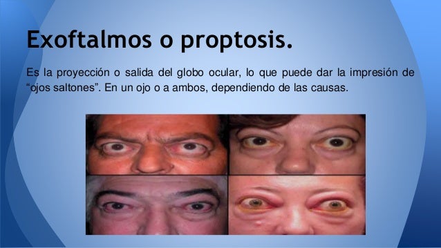 Patología vía lagrimal y exoftalmos.