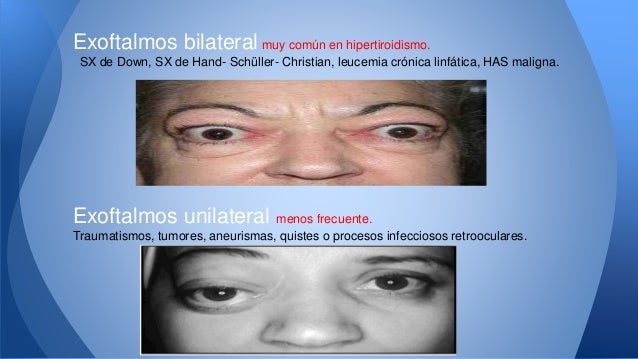 Patología vía lagrimal y exoftalmos.