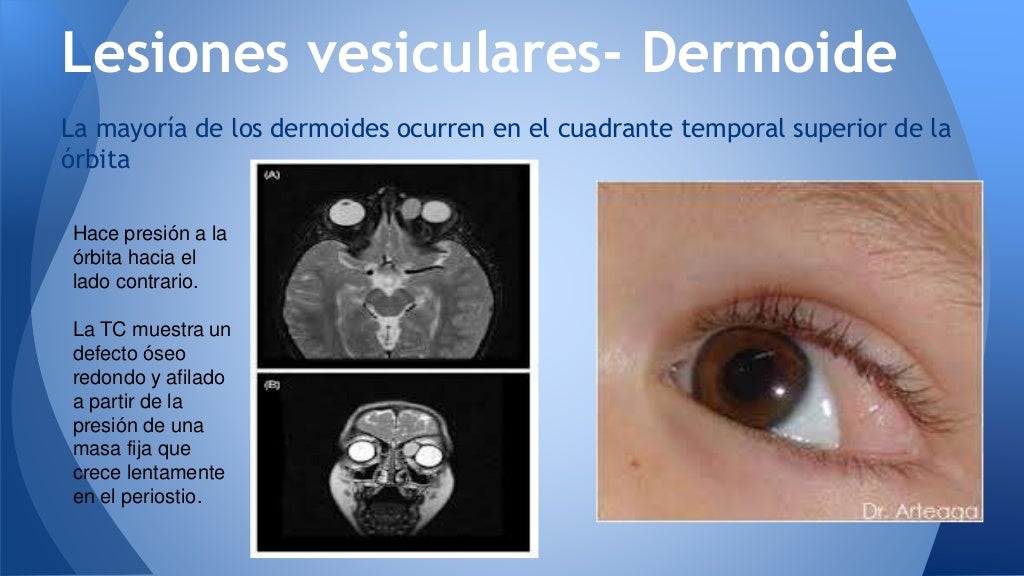 Patología vía lagrimal y exoftalmos.