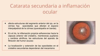 oftalmologia cataratas fisiología epidemiologia | PPTX