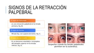 Oftalmopatía tiroidea | PPTX