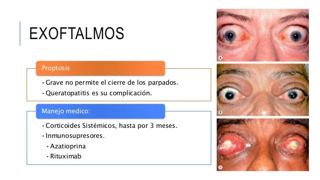 Oftalmopatía tiroidea