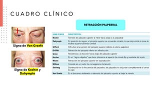 Enfermedad ocular u orbitopatía tiroidea. Oftalmopatía tiroidea ...