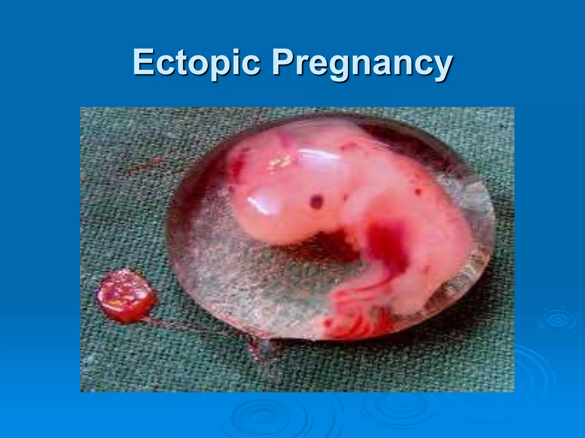 Ectopic Pregnancy.pptx