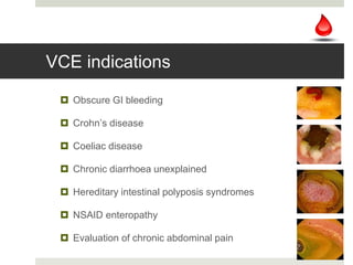 Obscure GI bleeding | PPTX