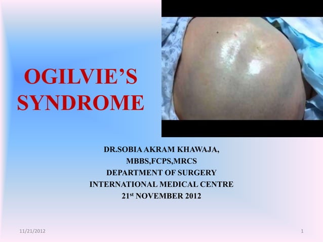 Ogilvies syndrome | PPT