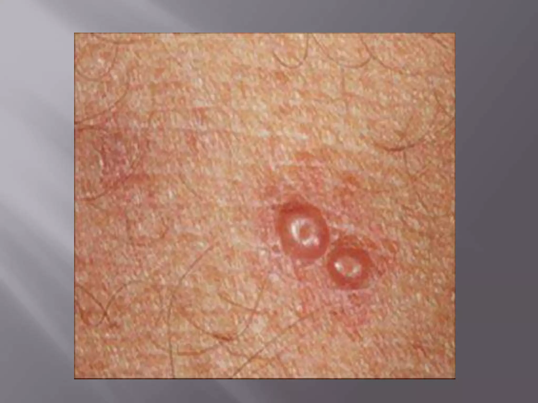 Common Sexually transmitted diseases (STD) | PPTX