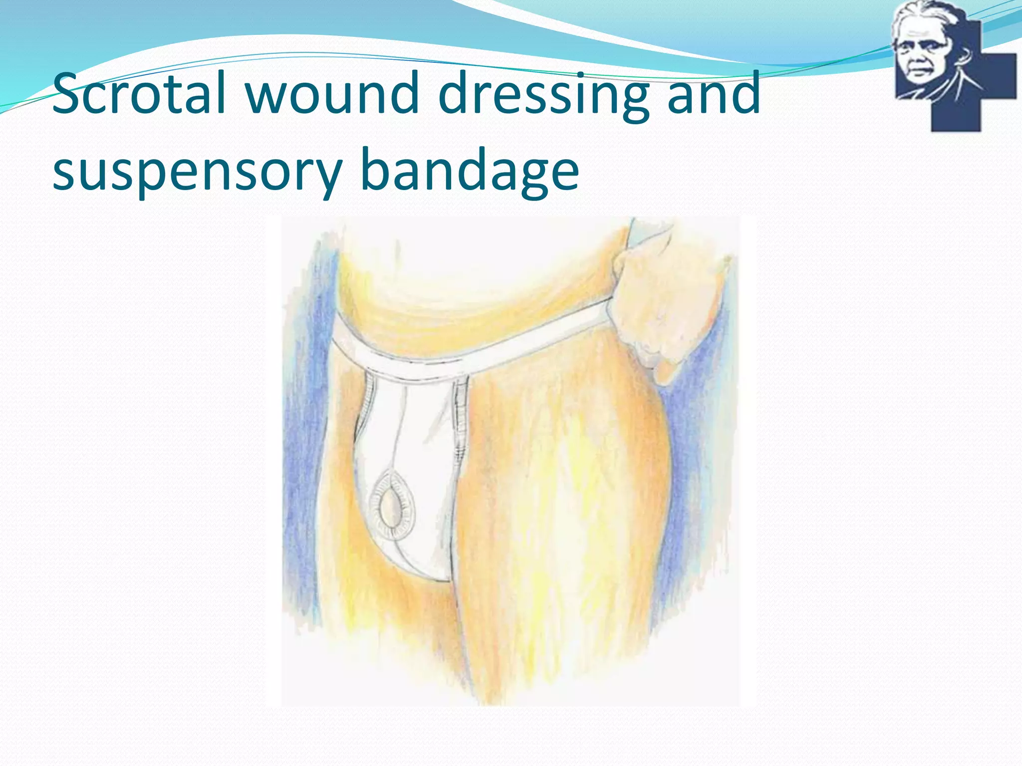 Vasectomy - Sterilization - No scalpel Vasectomy | PPTX