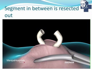 Vasectomy - Sterilization - No scalpel Vasectomy | PPTX