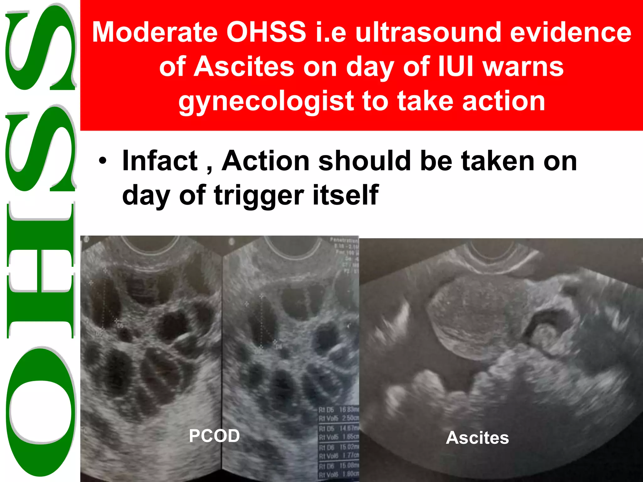 Medical Management of Ovarian Hyperstimulation Syndrome (OHSS) In 1500 ...