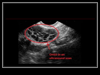 OVARIAN HYPERSTIMULATION SYNDROME OHSS.ppt