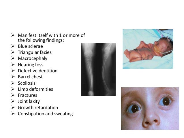Osteogenesis Imperfecta Type V Osteogenesis Imperfecta Figure 2 From