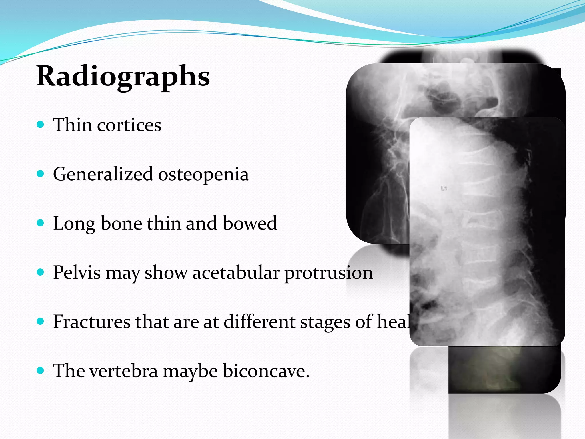 Osteogenesis Imperfecta | PPSX