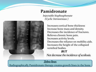 Osteogenesis Imperfecta | PPSX