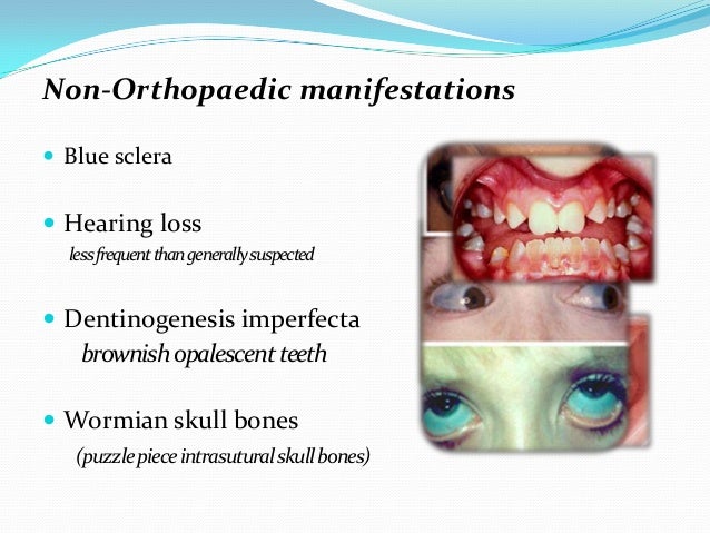 Osteogenesis Imperfecta