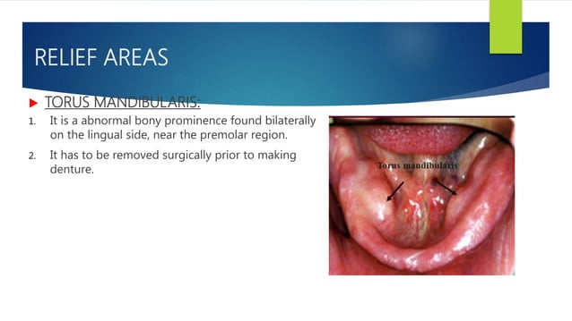 Anatomical landmarks of edentulous mandibular arch ppt (prosthodontics ...