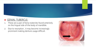 Anatomical landmarks of edentulous mandibular arch ppt (prosthodontics ...