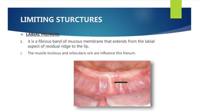 Anatomical landmarks of edentulous mandibular arch ppt (prosthodontics ...
