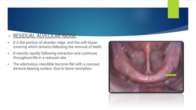 Anatomical landmarks of edentulous mandibular arch ppt (prosthodontics ...