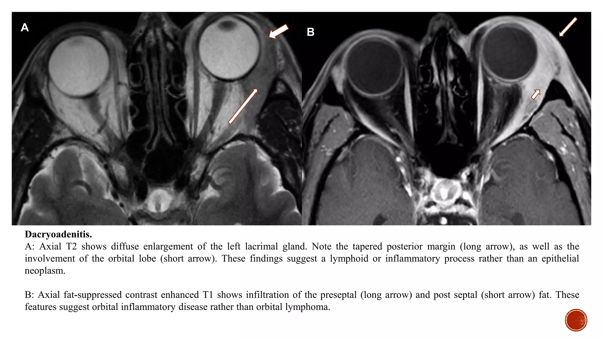 Orbital inflammatory disease | PPTX