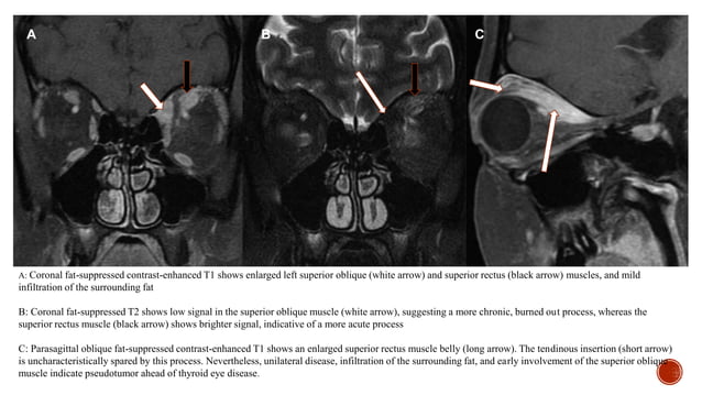 Orbital inflammatory disease | PPTX