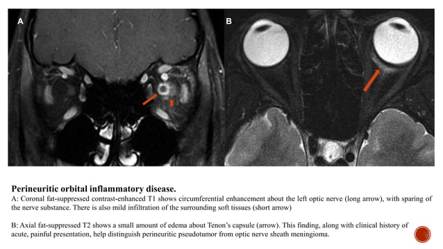 Orbital inflammatory disease | PPTX