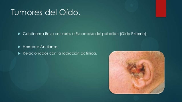 Oido (Tumores, Infecciones, Etc.)