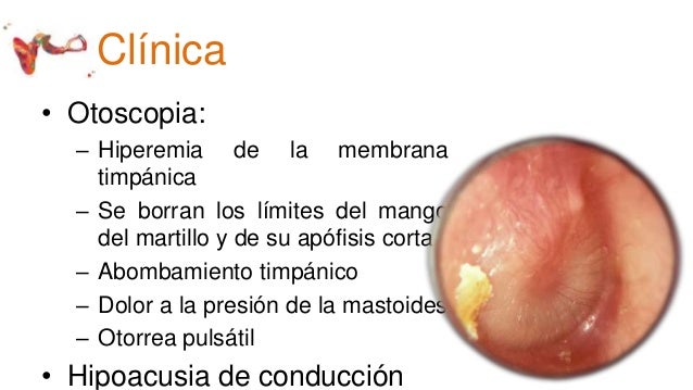 PATOLOGÍA INFLAMATORIA E INFECCIOSA DEL OIDO MEDIO