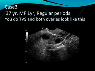 Ovulation induction in IUI | PPT