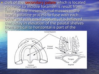 CLEFT LIP AND PALATE IN OMFS ADVANCED PPT | PPT
