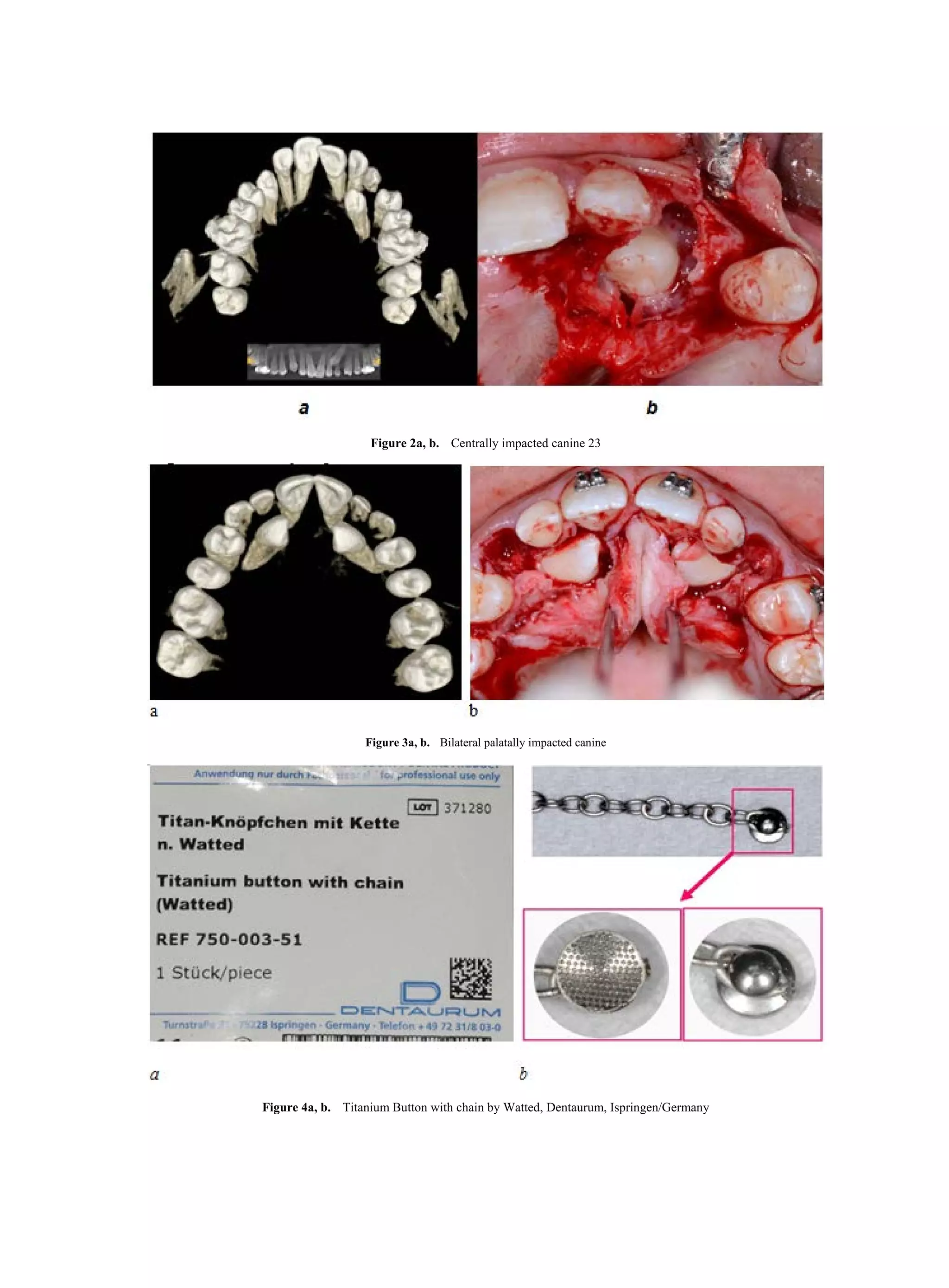 Surgery of Labially Impacted Canine & Orthodontic Management – A Case ...