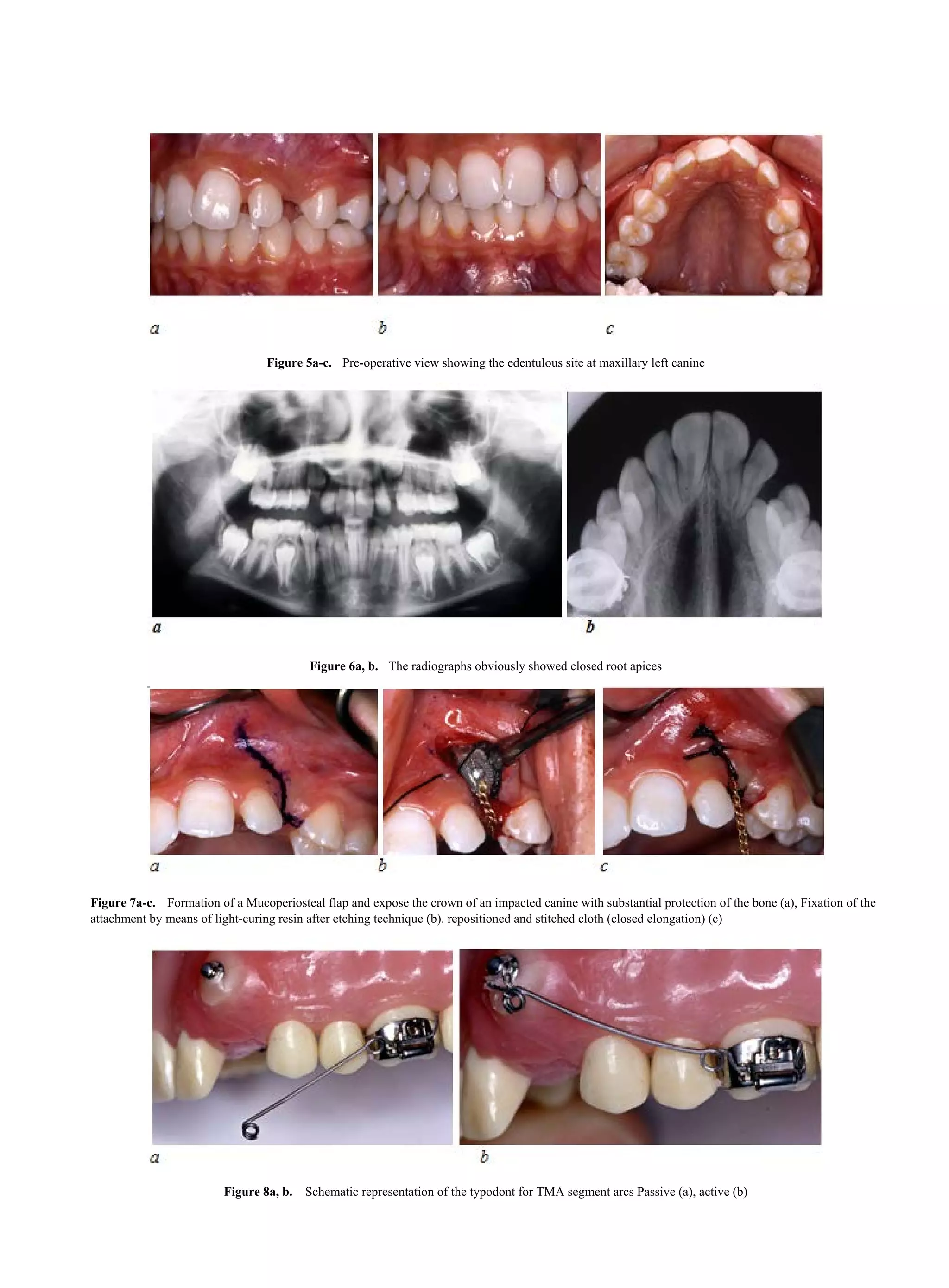 Surgery of Labially Impacted Canine & Orthodontic Management – A Case ...