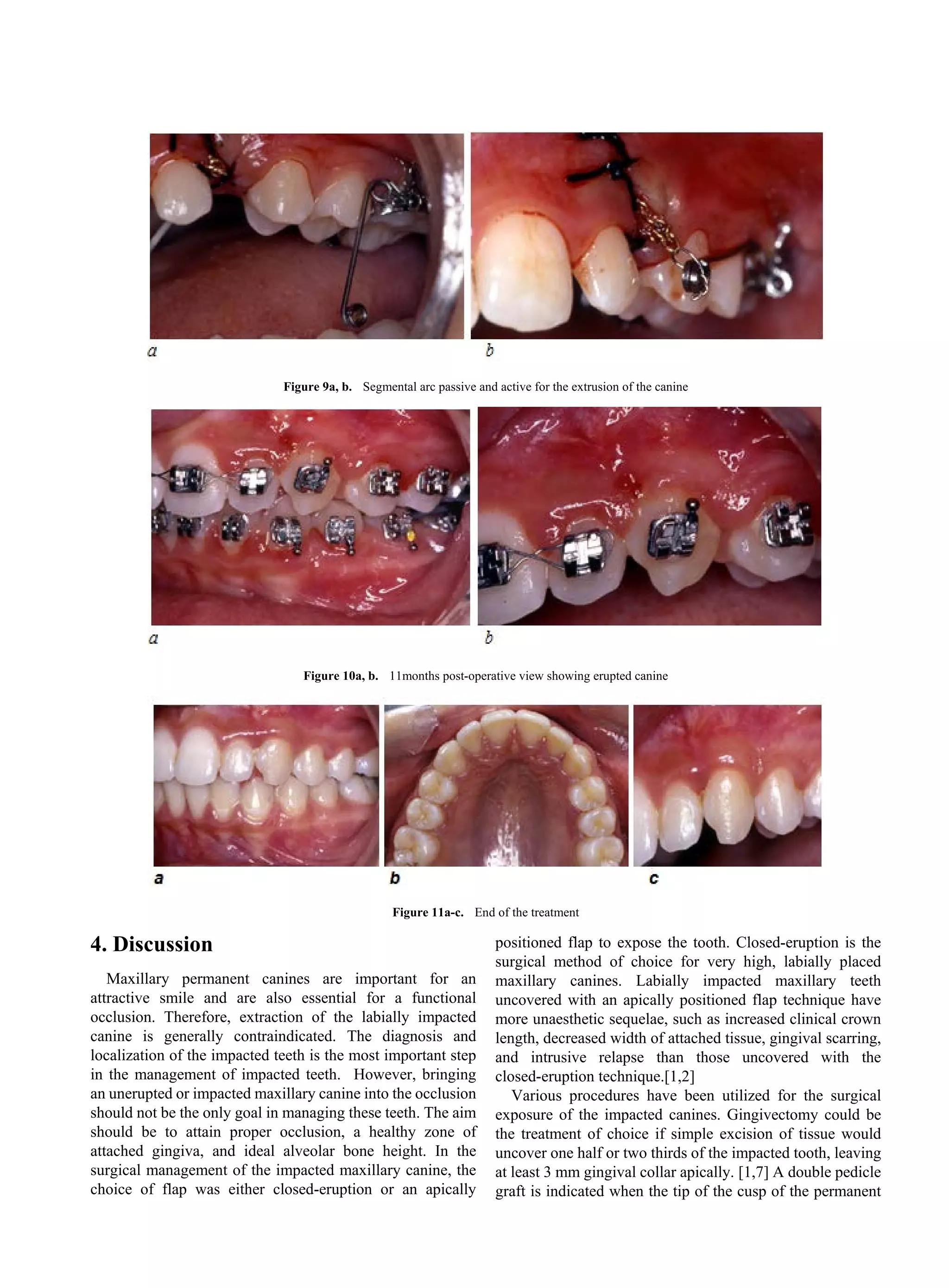 Surgery of Labially Impacted Canine & Orthodontic Management – A Case ...