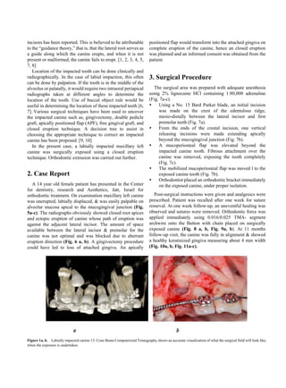 Surgery of Labially Impacted Canine & Orthodontic Management – A Case ...