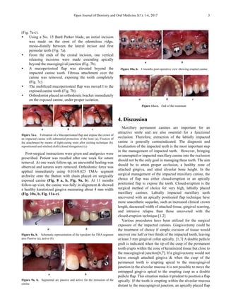 Surgery of Labially Impacted Canine & Orthodontic Management – A Case ...